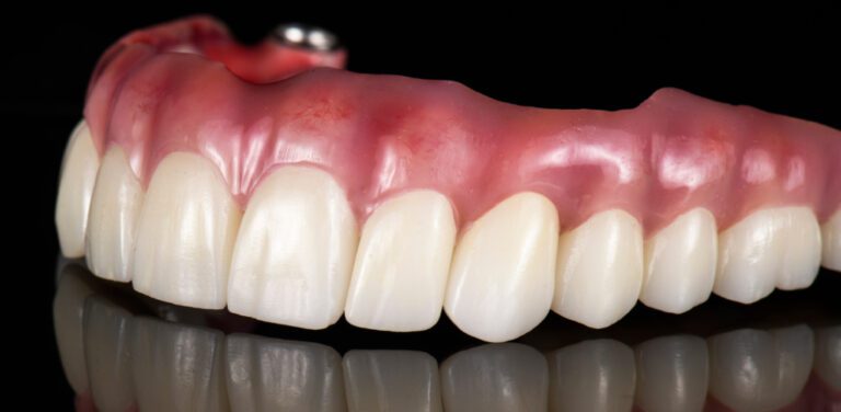 Hybrid Prosthesis - Dovey Dental